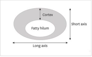 Lymph Node Ultrasound: Significance of Short Axis and Fatty Hilum | Dr ...